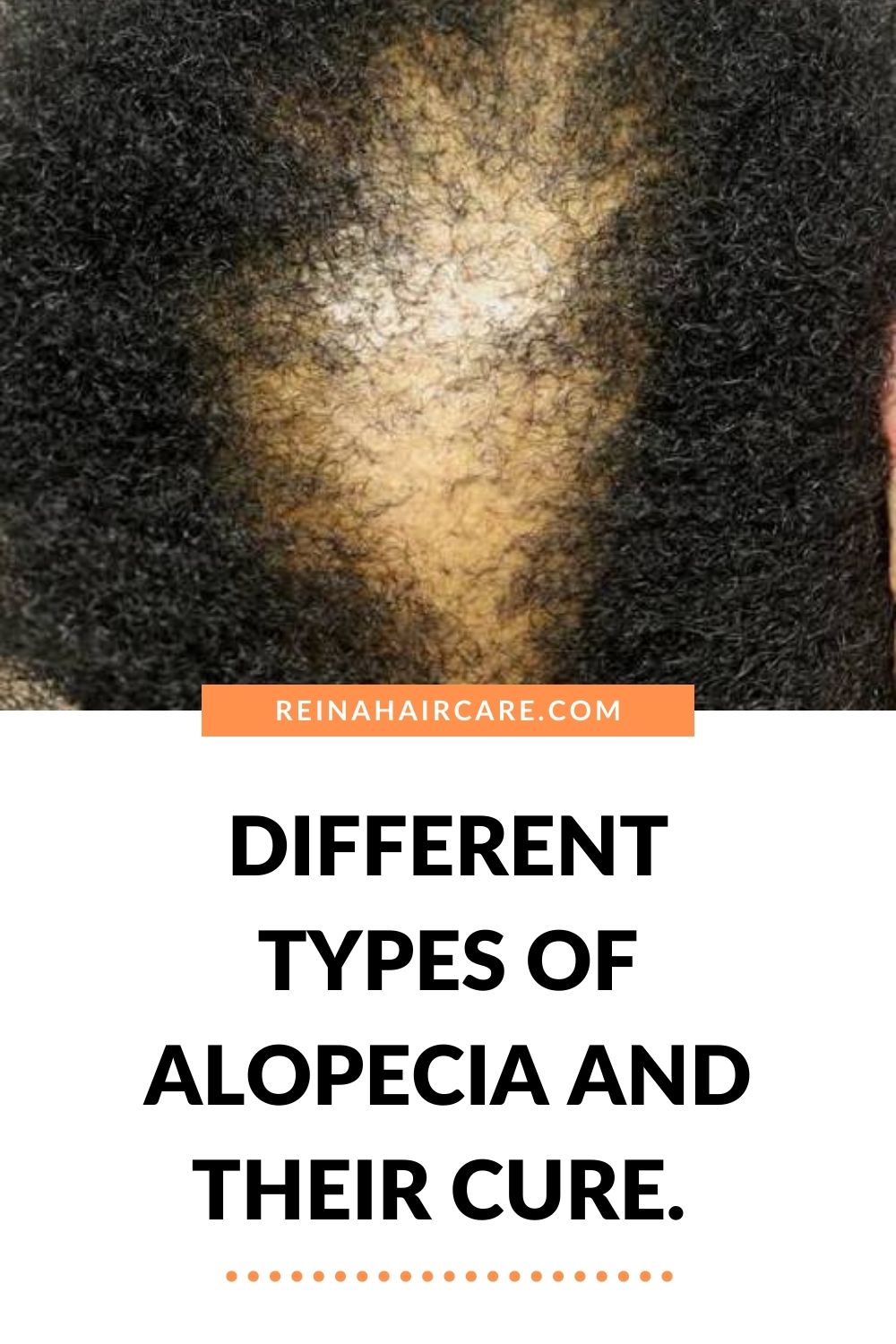 Different Types Of Alopecia and How To Treat Or Cure Them - Reina Haircare