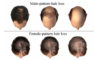 Different Types Of Alopecia and How To Treat Or Cure Them - Reina Haircare